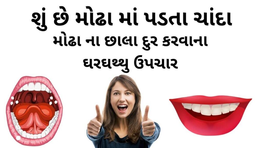 મોઢા ના છાલા દુર કરવાના ઘરઘથ્થુ ઉપચાર | Modha na chanda na upay