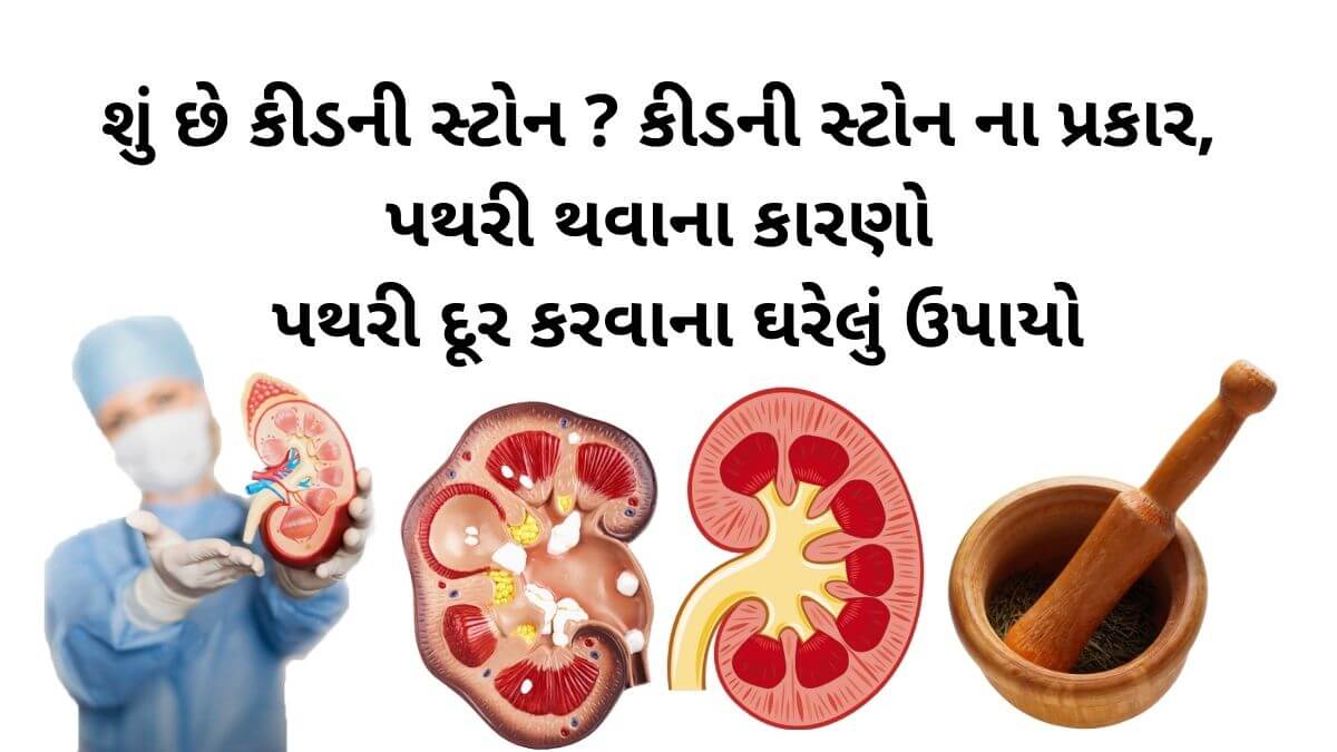 પથરી દૂર કરવાના ઉપાયો | પથરી થવાના કારણો | pathari ni dava gujarati ma